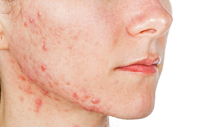 Acné treatment :: hetbeautyatelier.nl